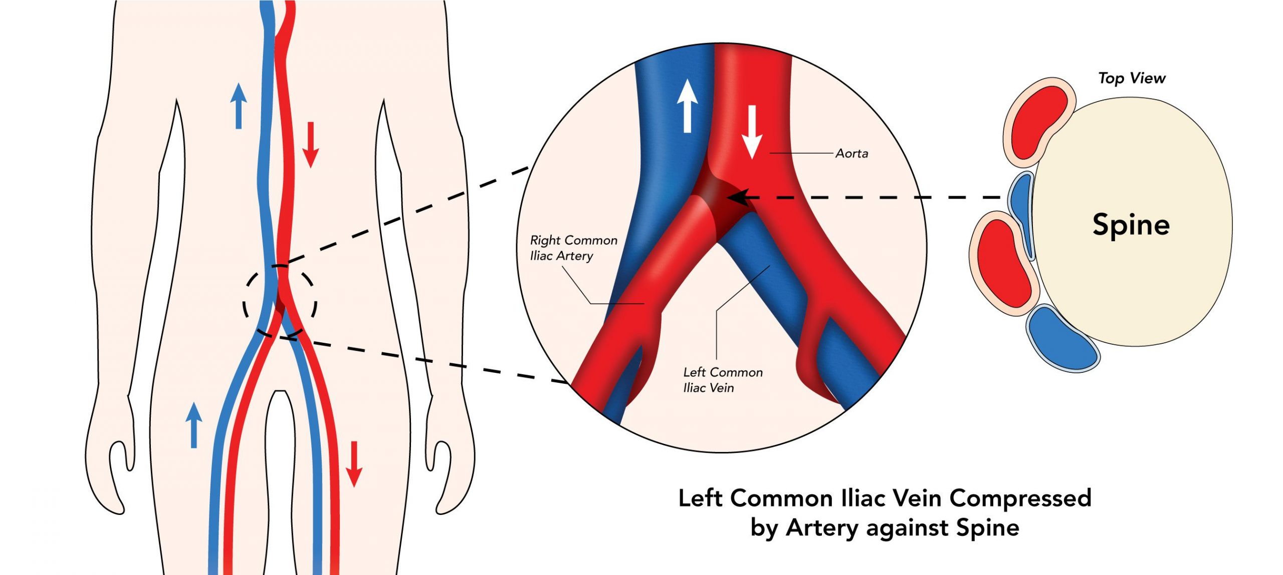 Compression Of Iliac Vein